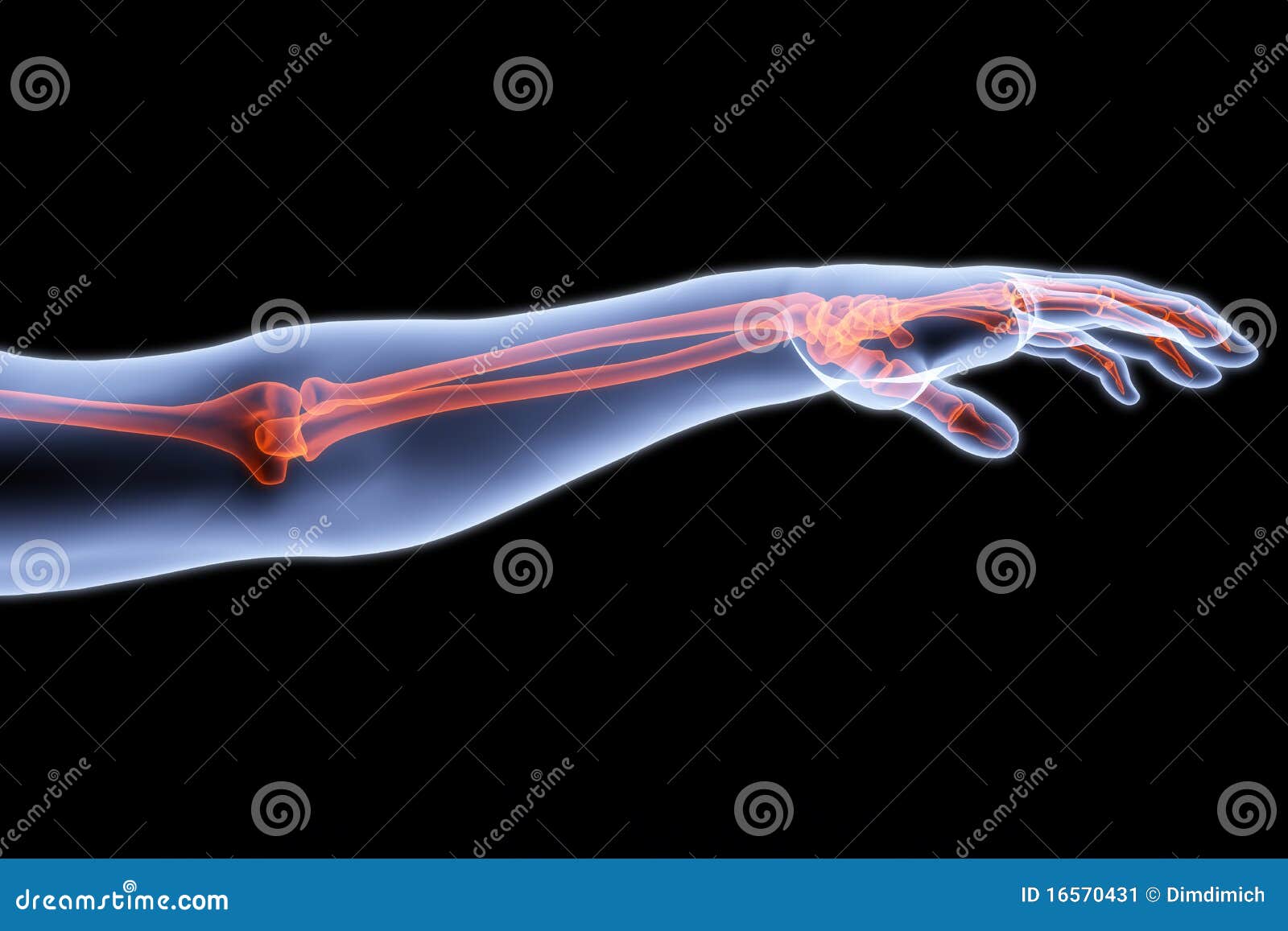 Radiogram Of Hand. X-ray Or Roentgenogram. Vector Illustration Of ...