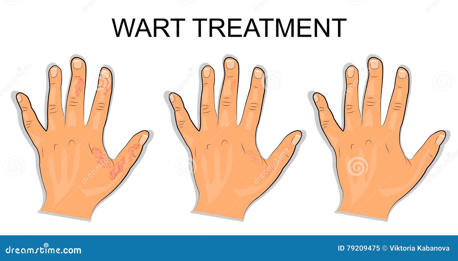 Verrucae Cartoons, Illustrations & Vector Stock Images - 8 Pictures to ...