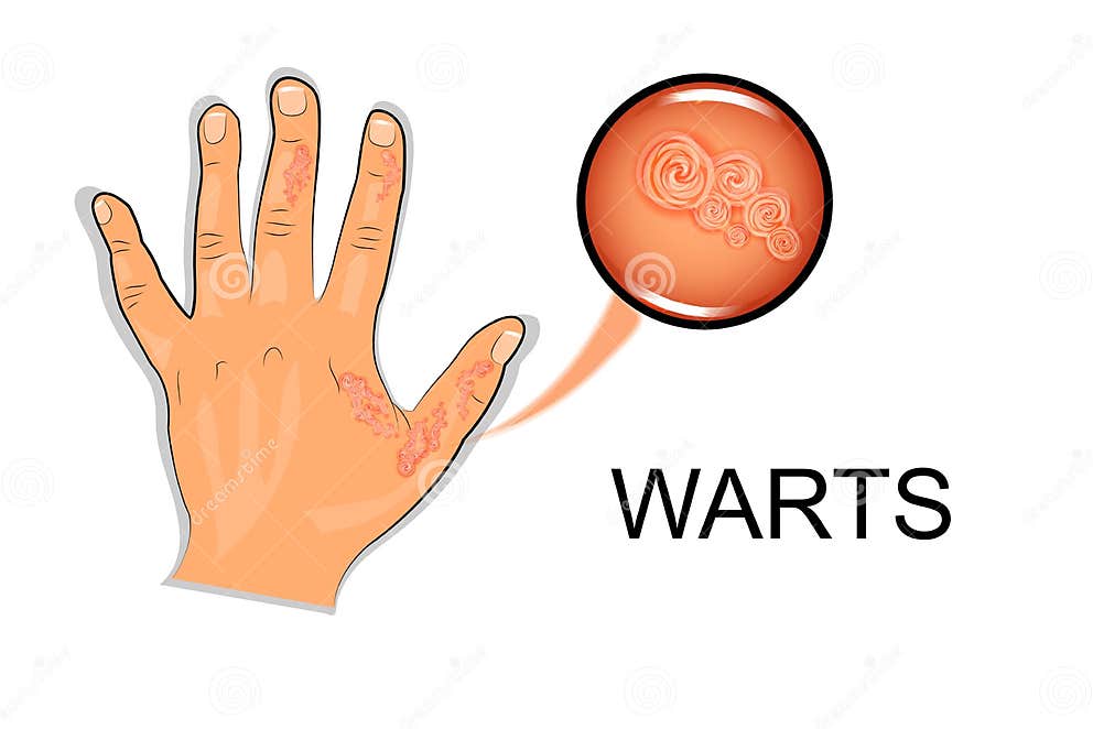 Hand affected by the wart stock vector. Illustration of detailed - 79209523