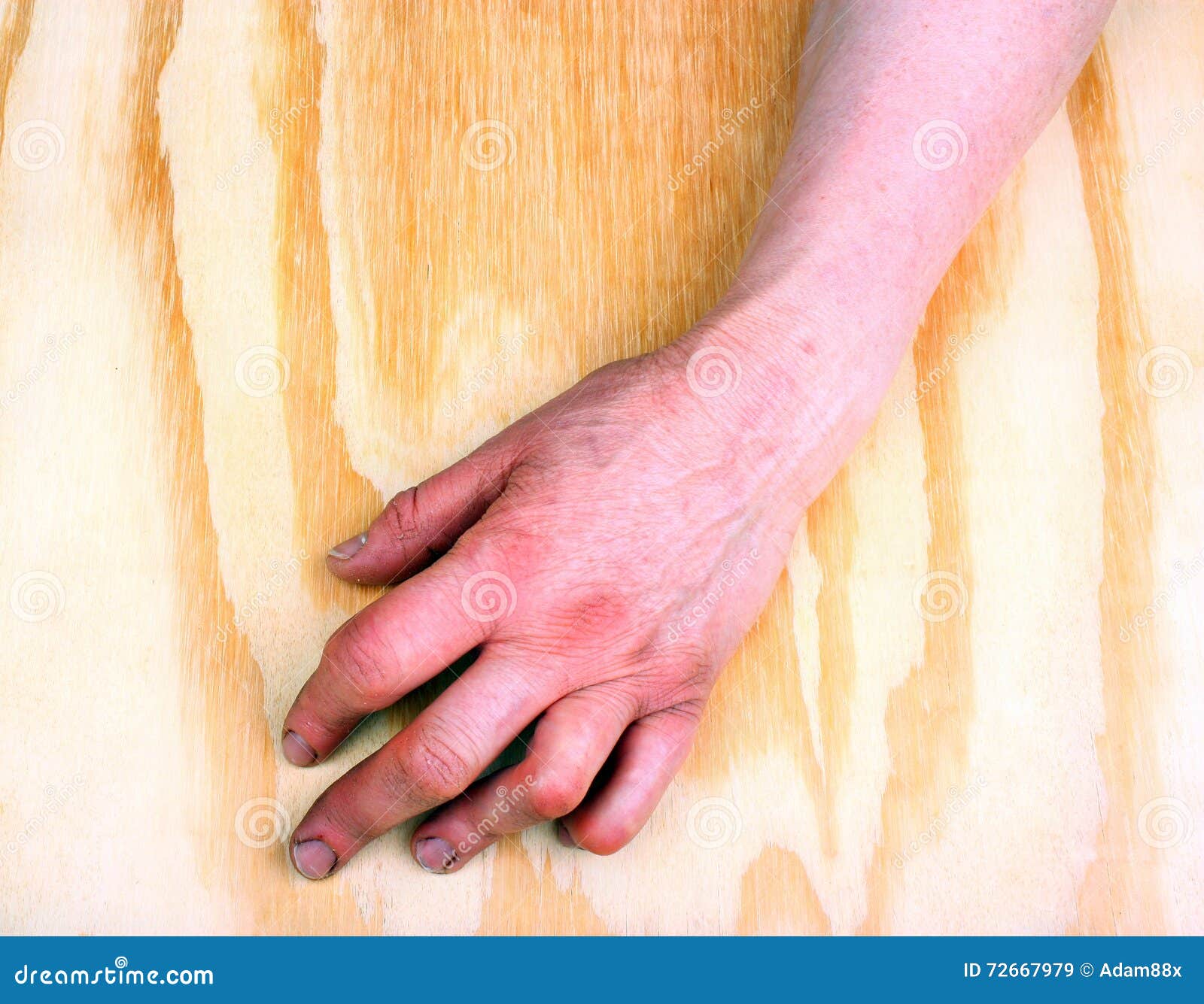 Hand Deformed From Rheumatoid Arthritis Stock Photography ...