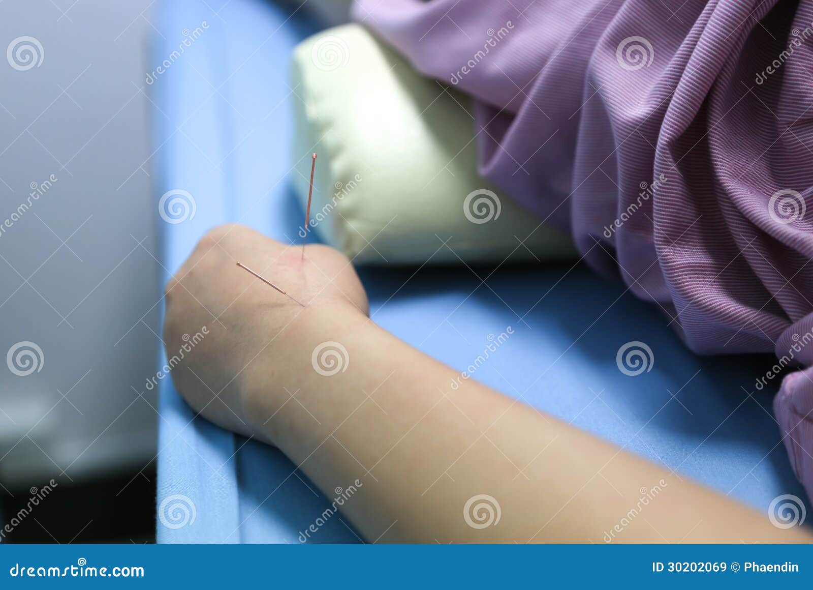 Hand of a Woman with Acupuncture Treatment Stock Image - Image of ...