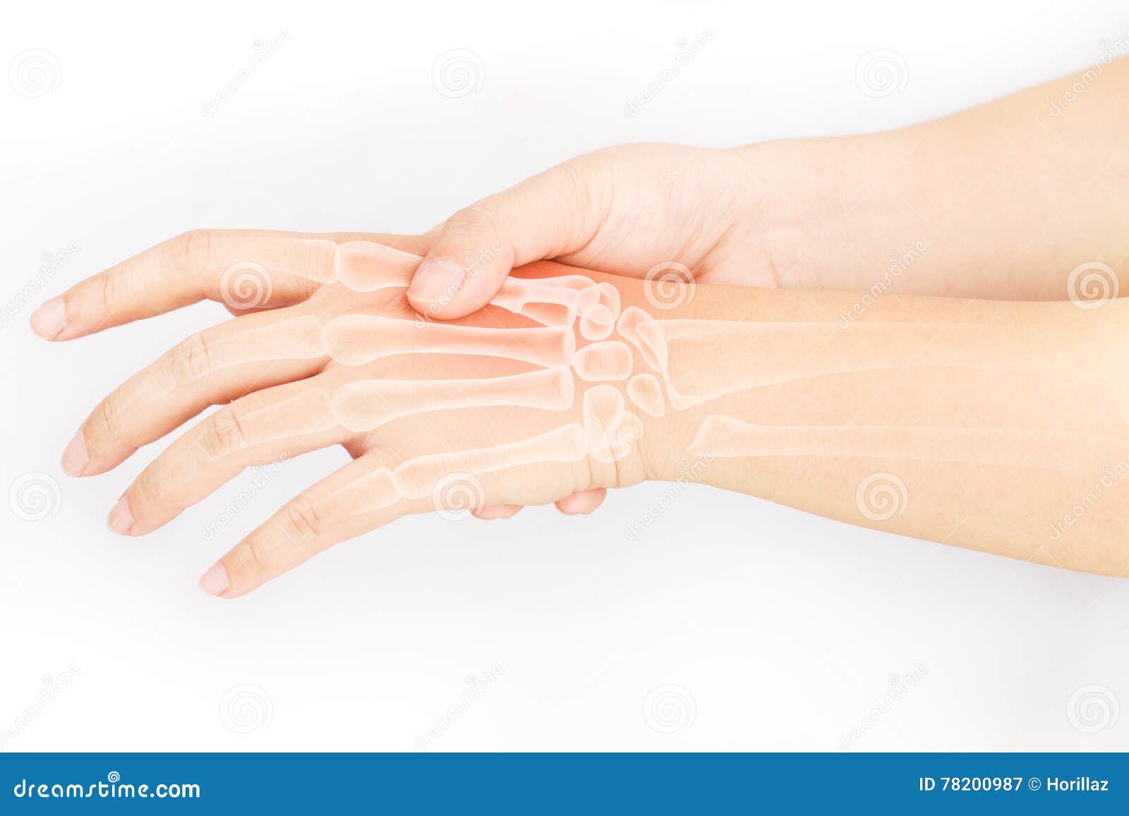 Hand bone pain stock image. Image of joints, fracture - 78200987