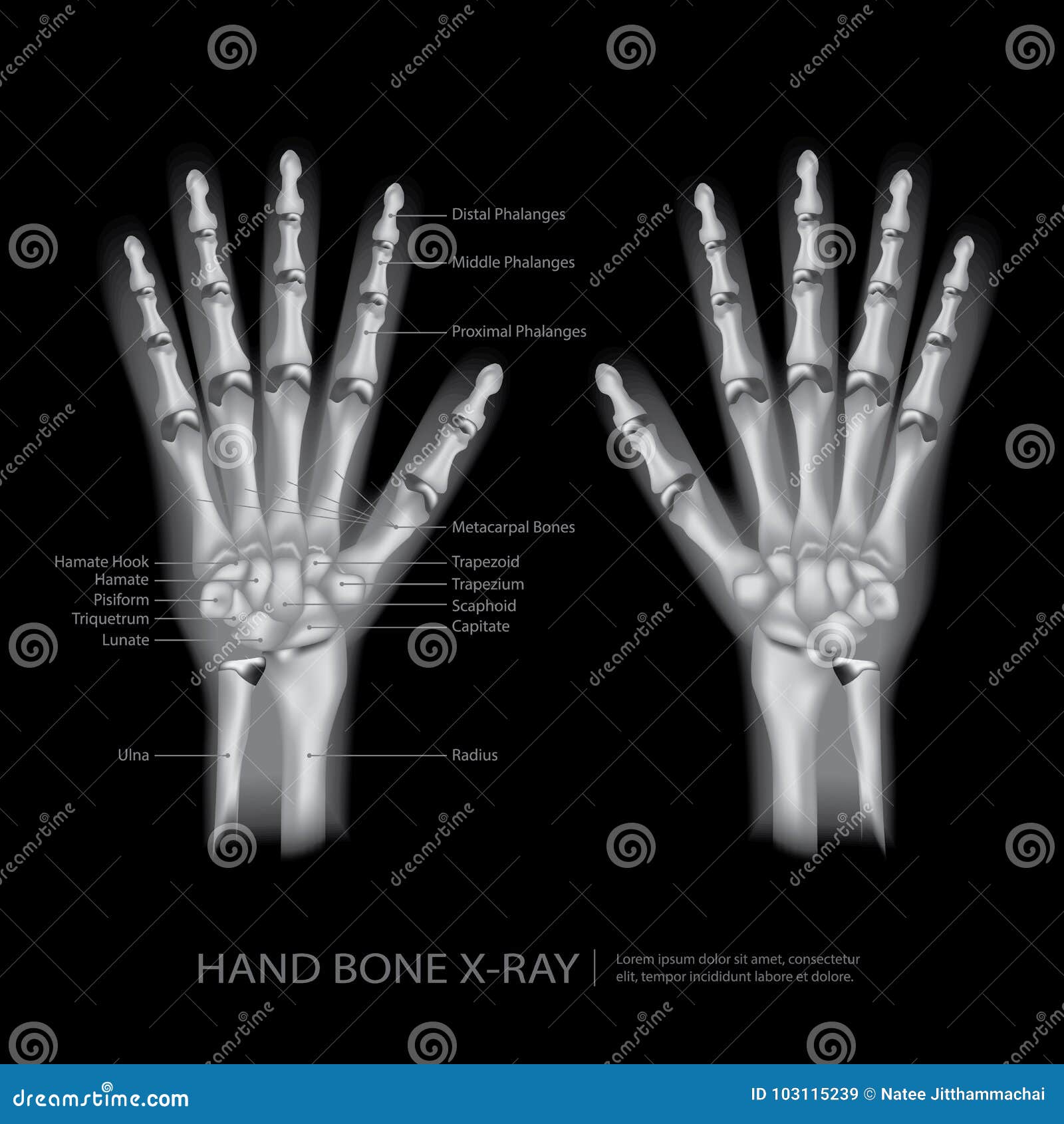Hand Bone X-Ray stock vector. Illustration of health - 103115239