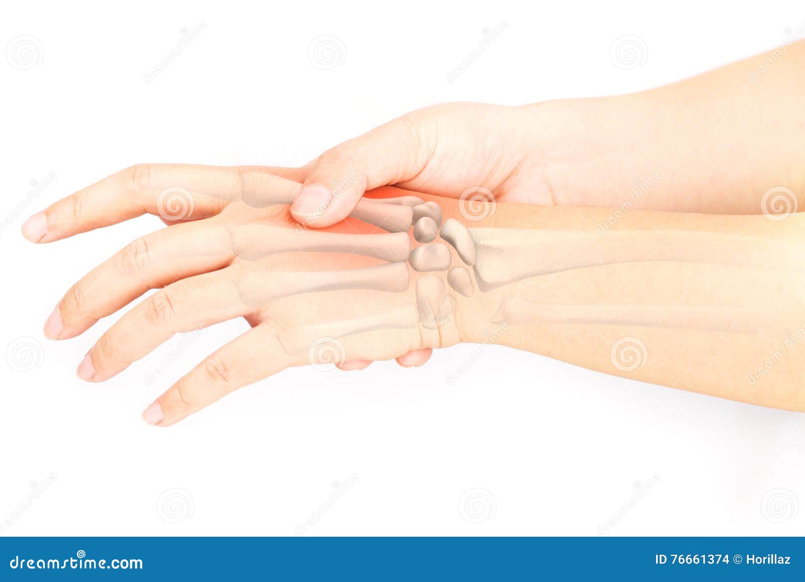 Hand bones injury stock photo. Image of ache, osteoarthritis - 76661374