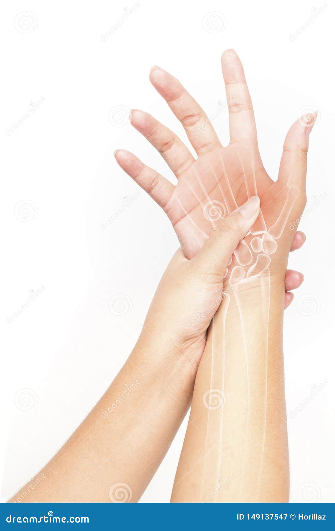 Hand bones injury stock image. Image of metacarpal, inflame - 149137547