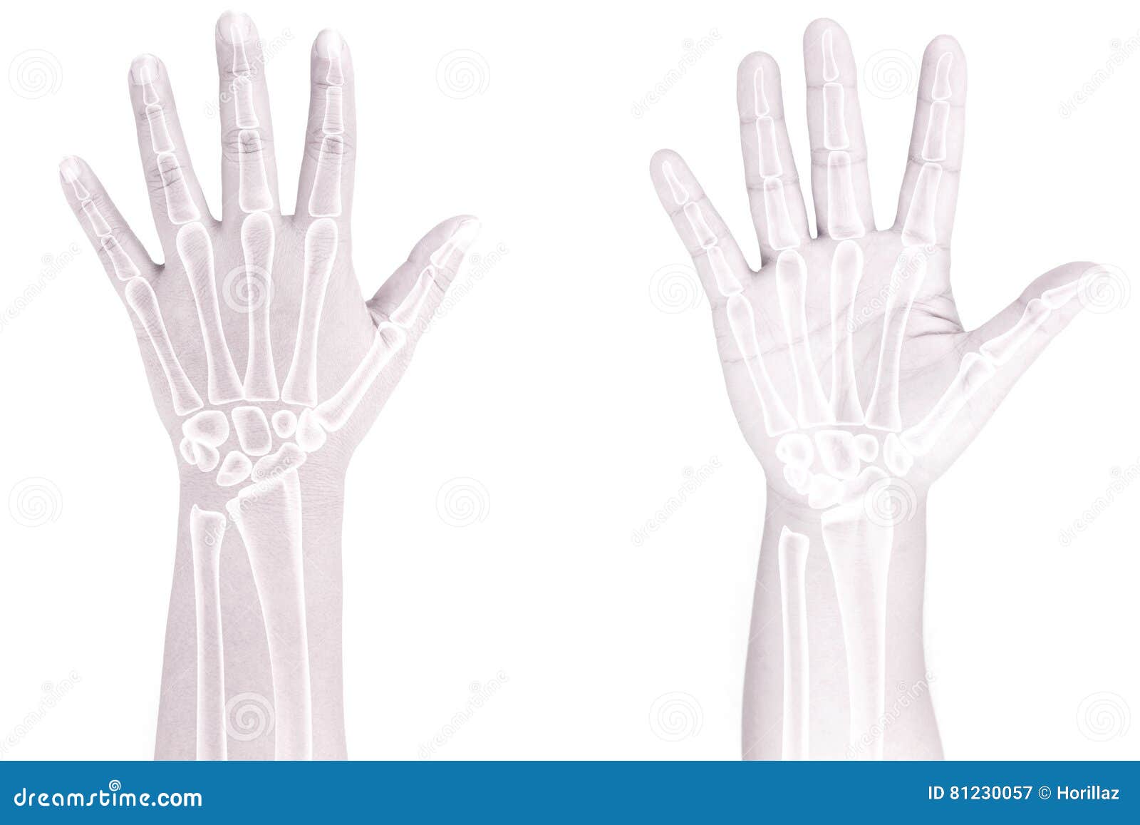 Hand bones stock image. Image of carpal, injury, office - 81230057