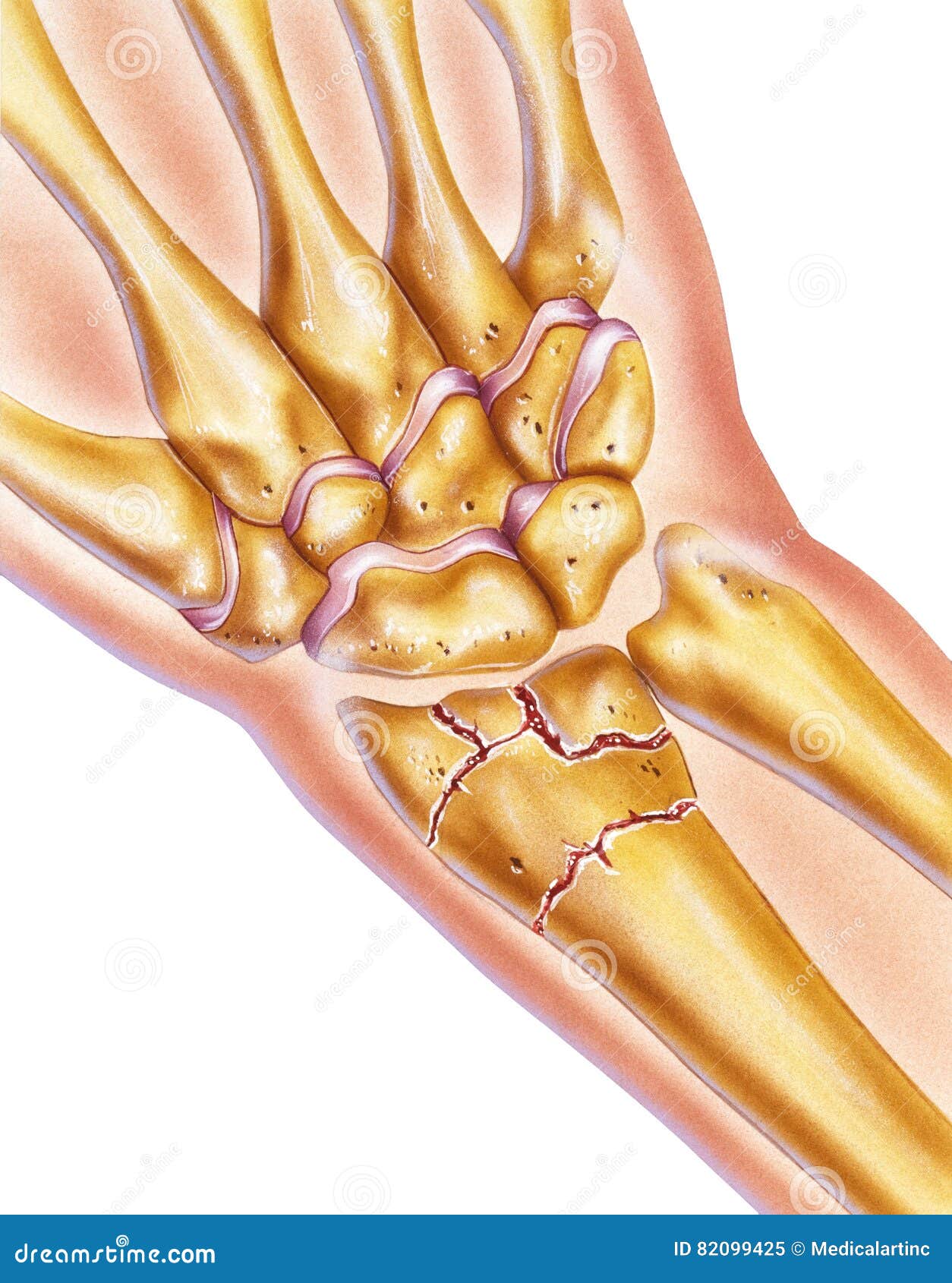 Hand and Broken Wrist stock illustration. Illustration of skeleton ...