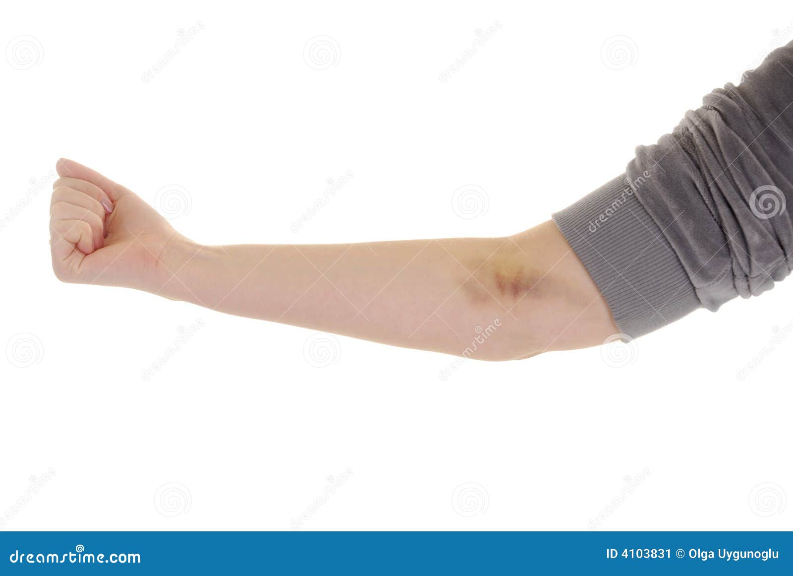 Hand with bruise stock image. Image of medical, girl, care - 4103831