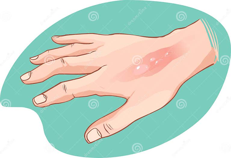 Hand burn stock vector. Illustration of medicine, thumb - 53657240