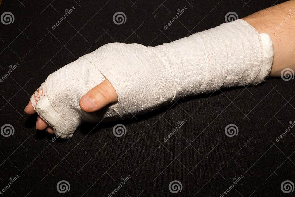 Hand in a cast. stock photo. Image of bone, joint, hand - 92930720
