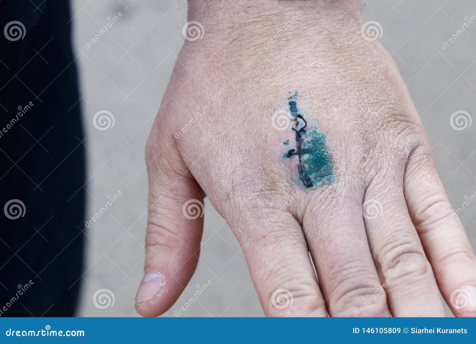 Hand Close Up. On It Is Cut And Sewn With Thread. Natural Refreshment ...