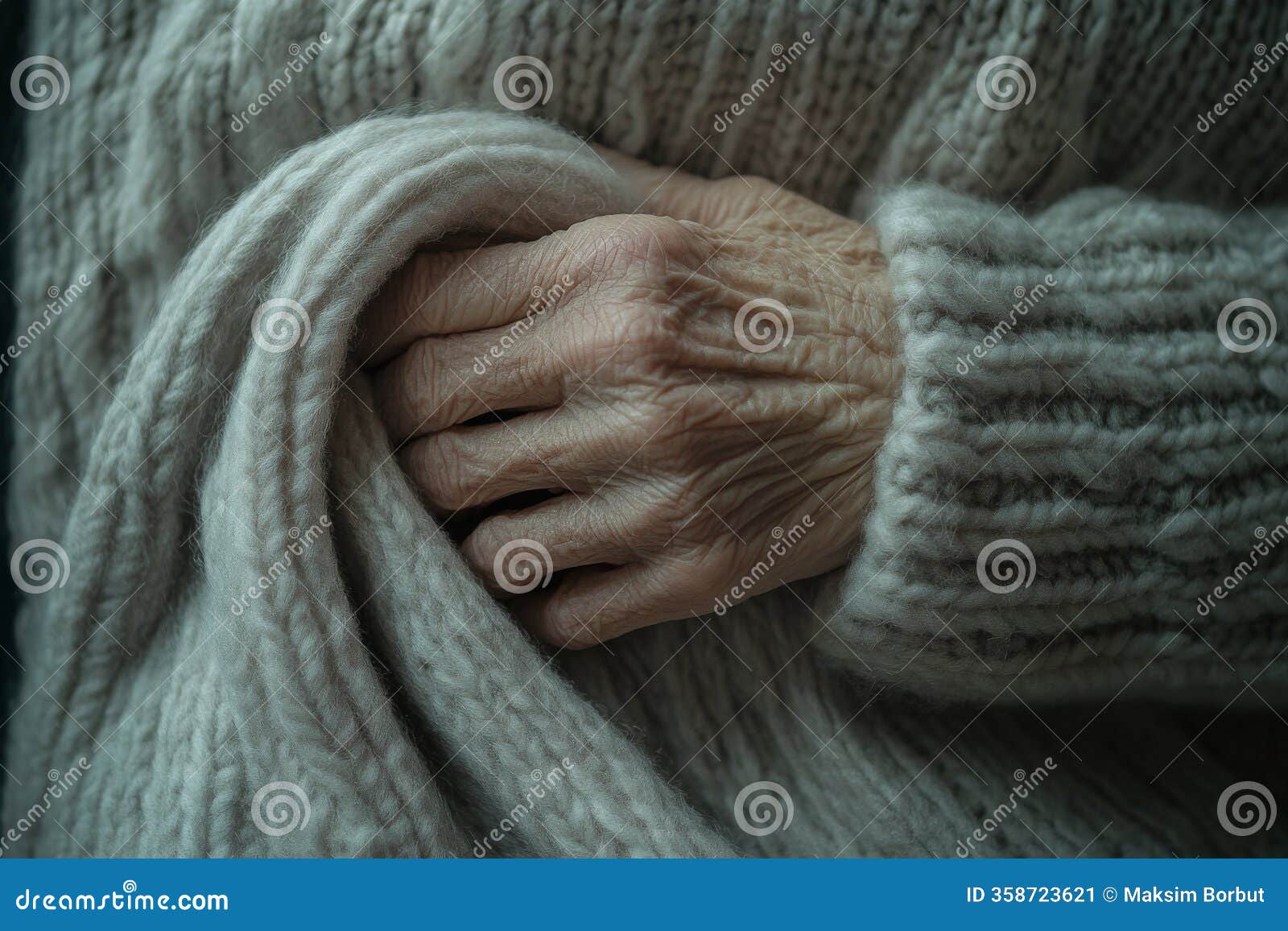 Hand Close Up Displaying Psoriasis Skin Condition with Texture Details ...