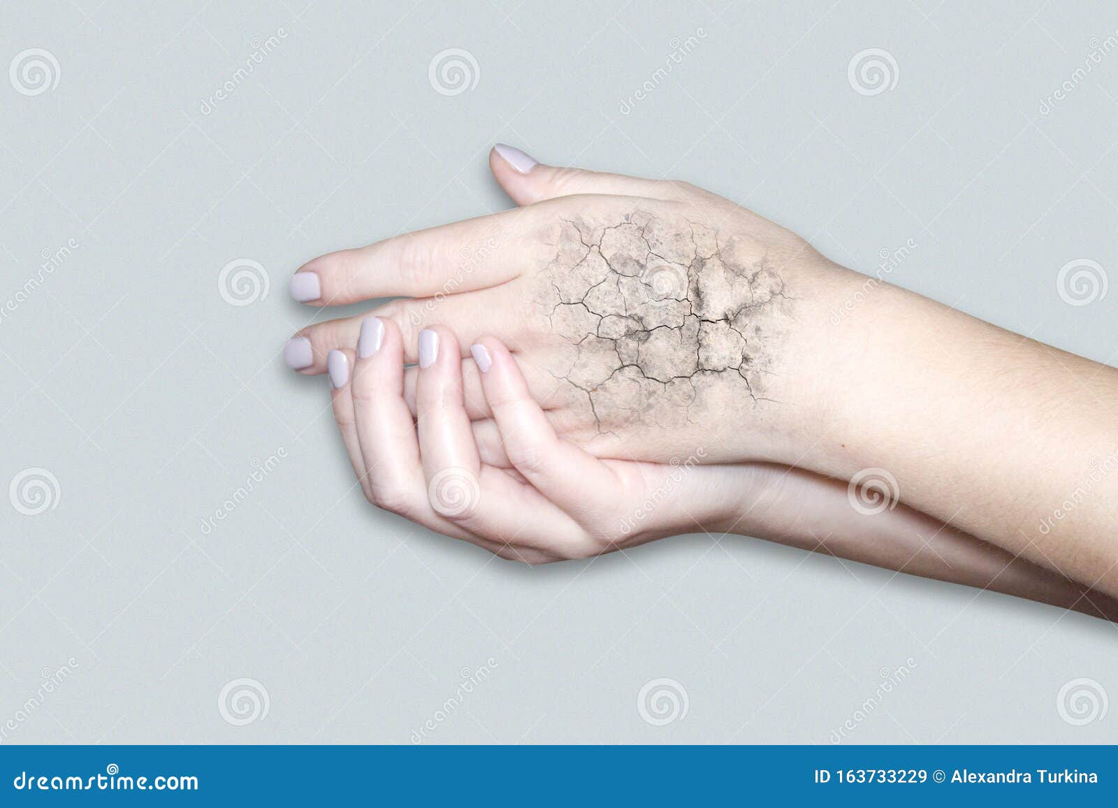 Hand with Cracked Skin. Cracked Skin, Dry Skin. Skin Care in Winter ...