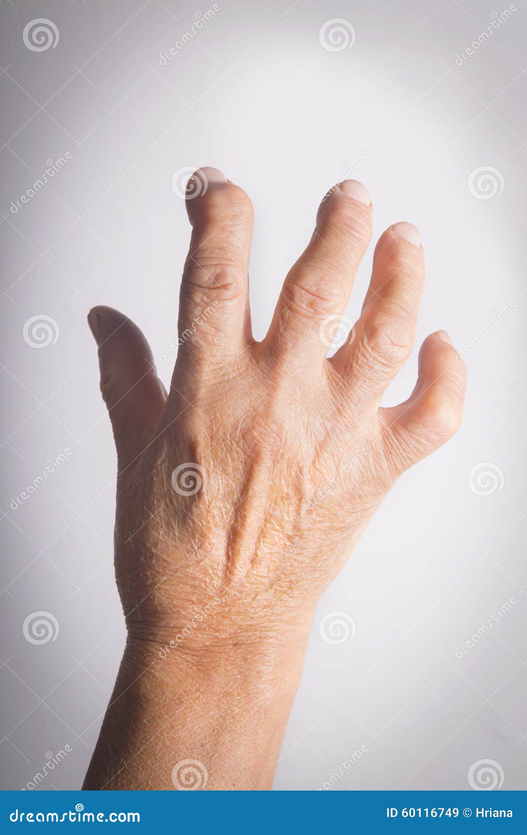 Hand Deformed from Rheumatoid Arthritis Stock Image - Image of human ...