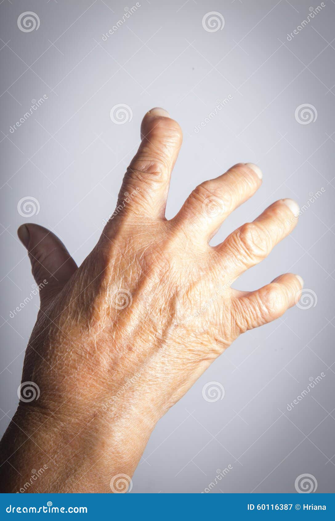 Hand Deformed From Rheumatoid Arthritis Stock Photo - Image: 60116387