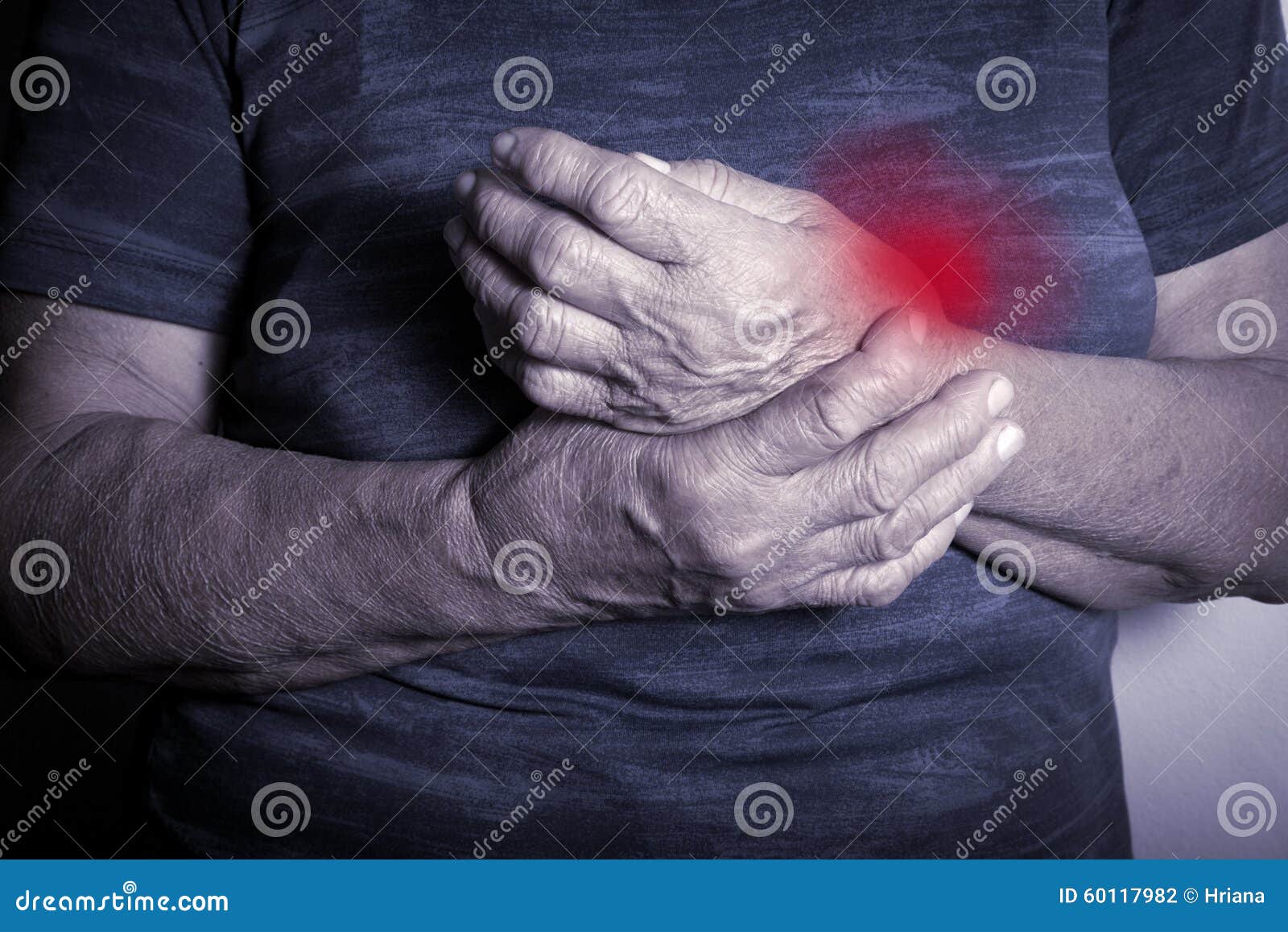 Hand Deformed from Rheumatoid Arthritis Stock Photo - Image of ...