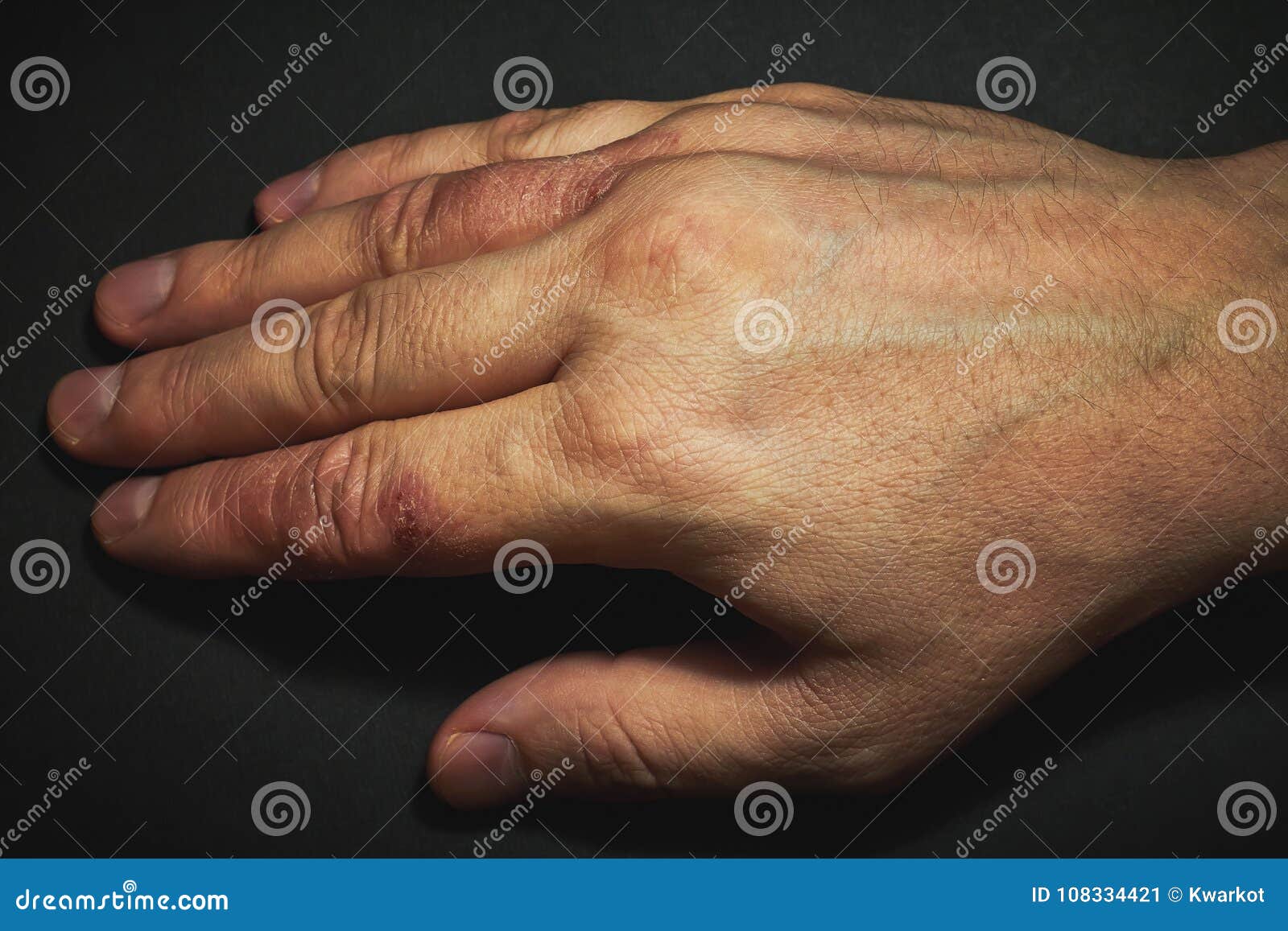 Hand Dermatitis. Hand Eczema Royalty-Free Stock Image | CartoonDealer ...