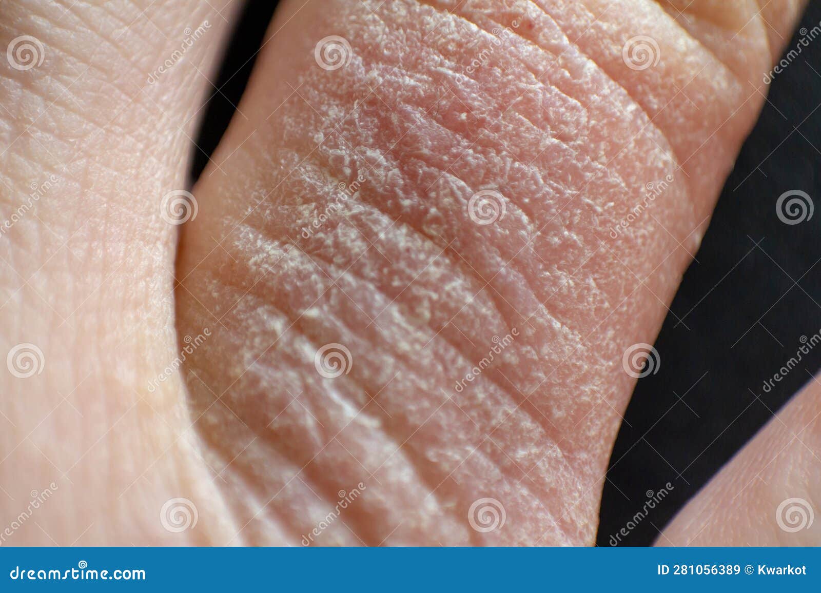 Hand With Dermatitis Red Itchy Swollen Skin After Touching Nettle ...