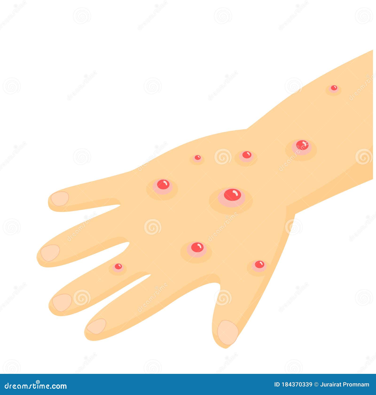 Hand Disease Vector stock vector. Illustration of applying - 184370339