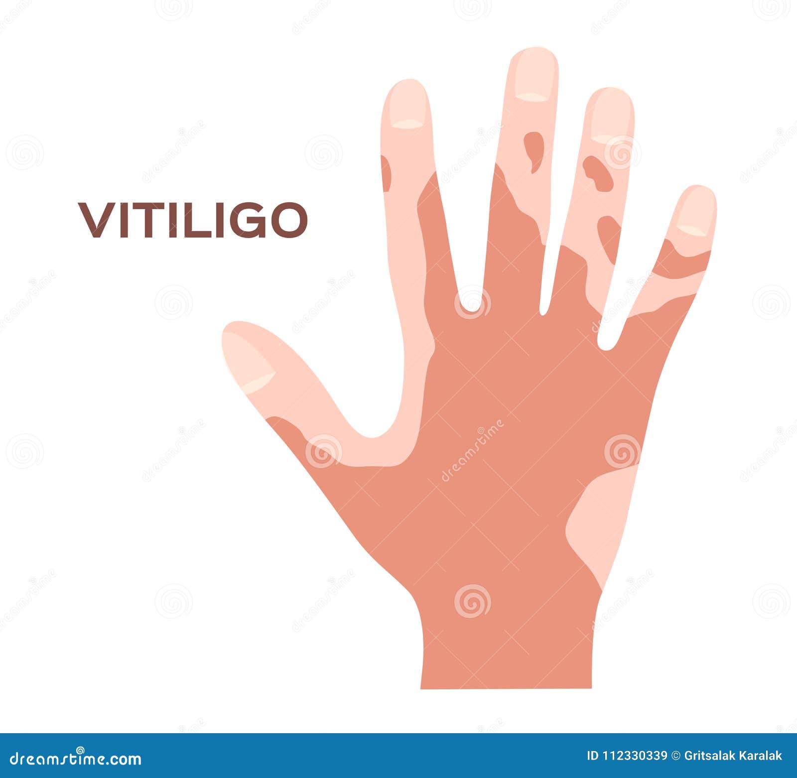 Hand With Vitiligo And Structure Of Skin Cells As A Concept For Melanin ...