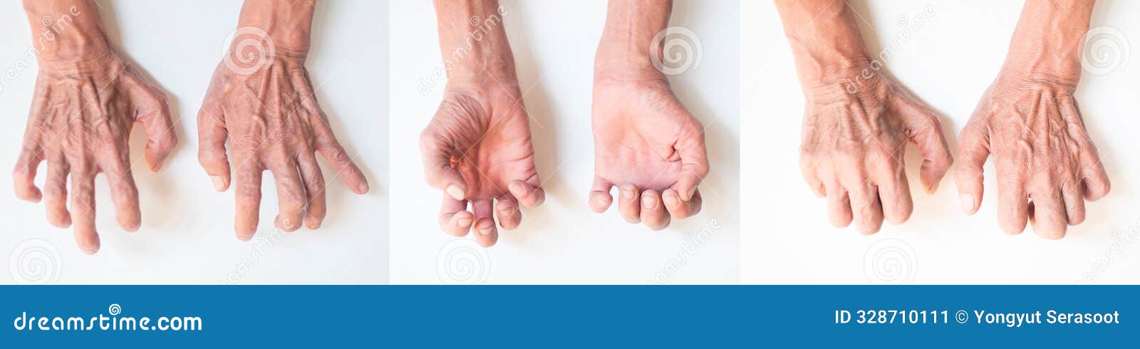 Hand and Finger Symptoms of the Elderly with Bone and Tendon Symptoms ...