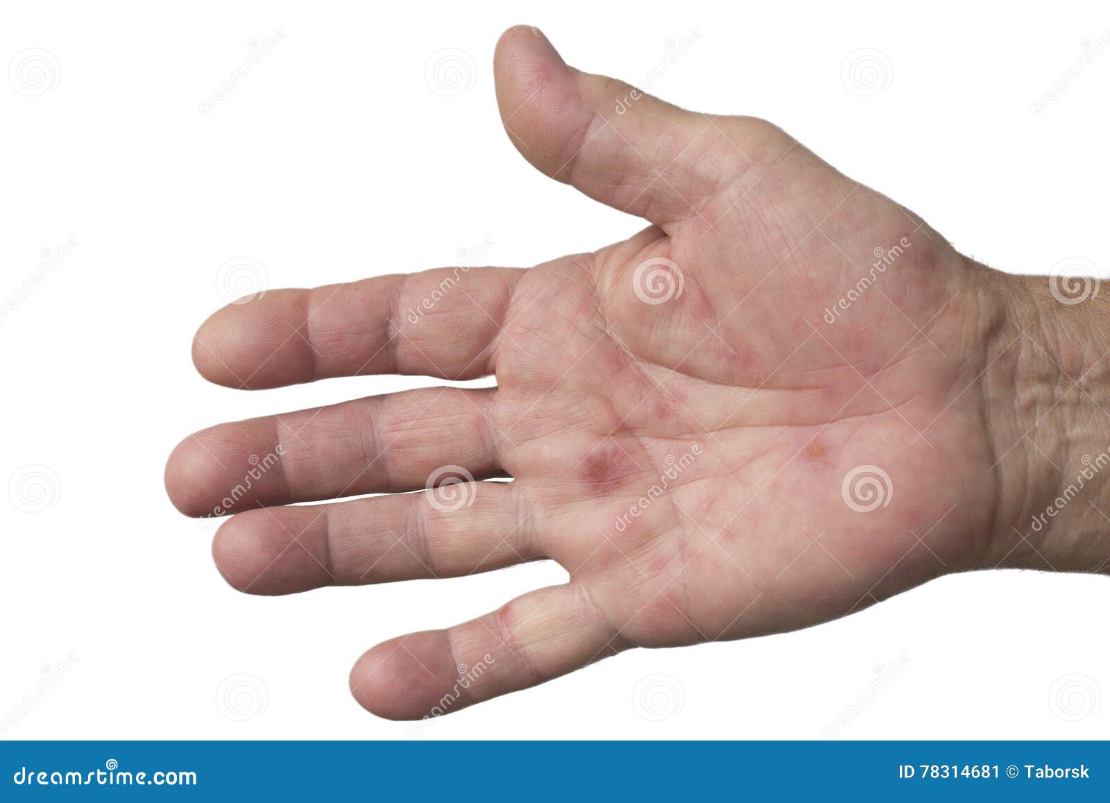 Hand, Foot and Mouth Disease Stock Image - Image of sick, eczema: 78314681