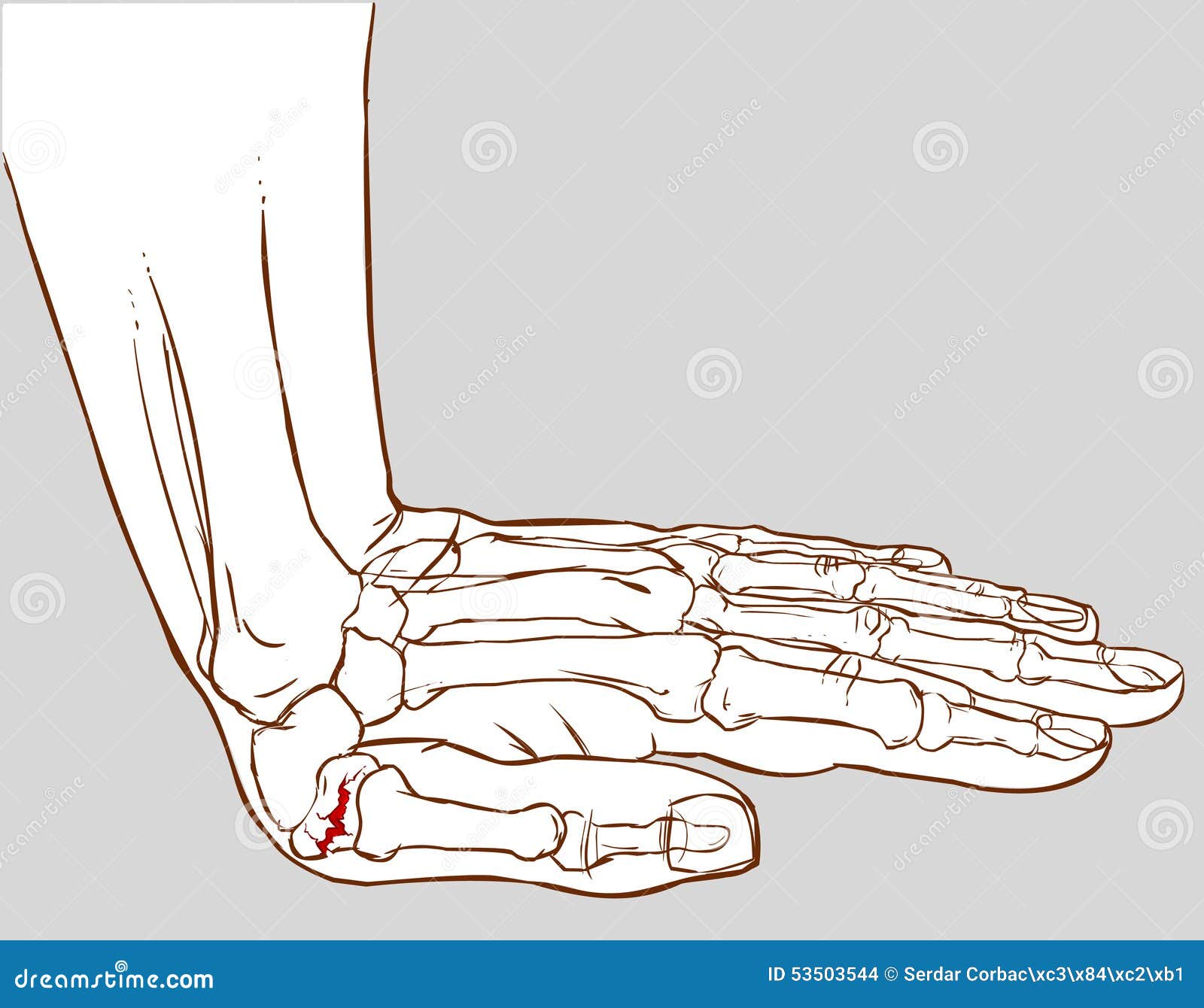 Hand fracture stock vector. Illustration of injured, ache - 53503544