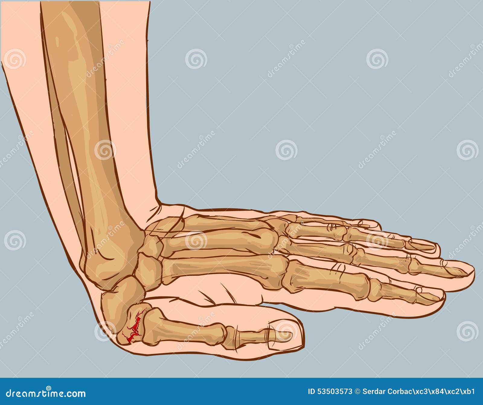 Hand fracture stock vector. Illustration of sick, bones - 53503573