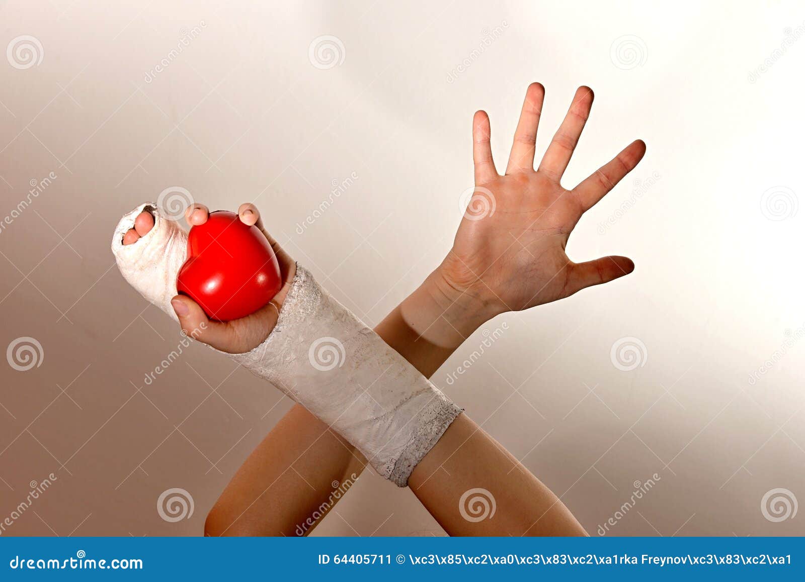 Hand im Gips stockbild. Bild von aufgewickelt, gips, knochen - 64405711