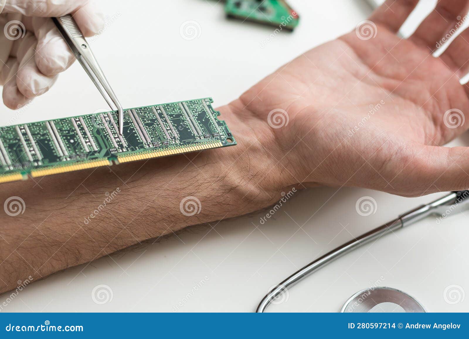 Hand with Implantation of Micro Chip. X-Ray View Close-up. Chipization ...