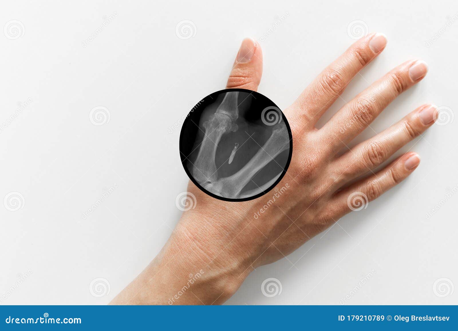 Hand with Implantation of Micro Chip. X-Ray View Close-up Stock Image ...