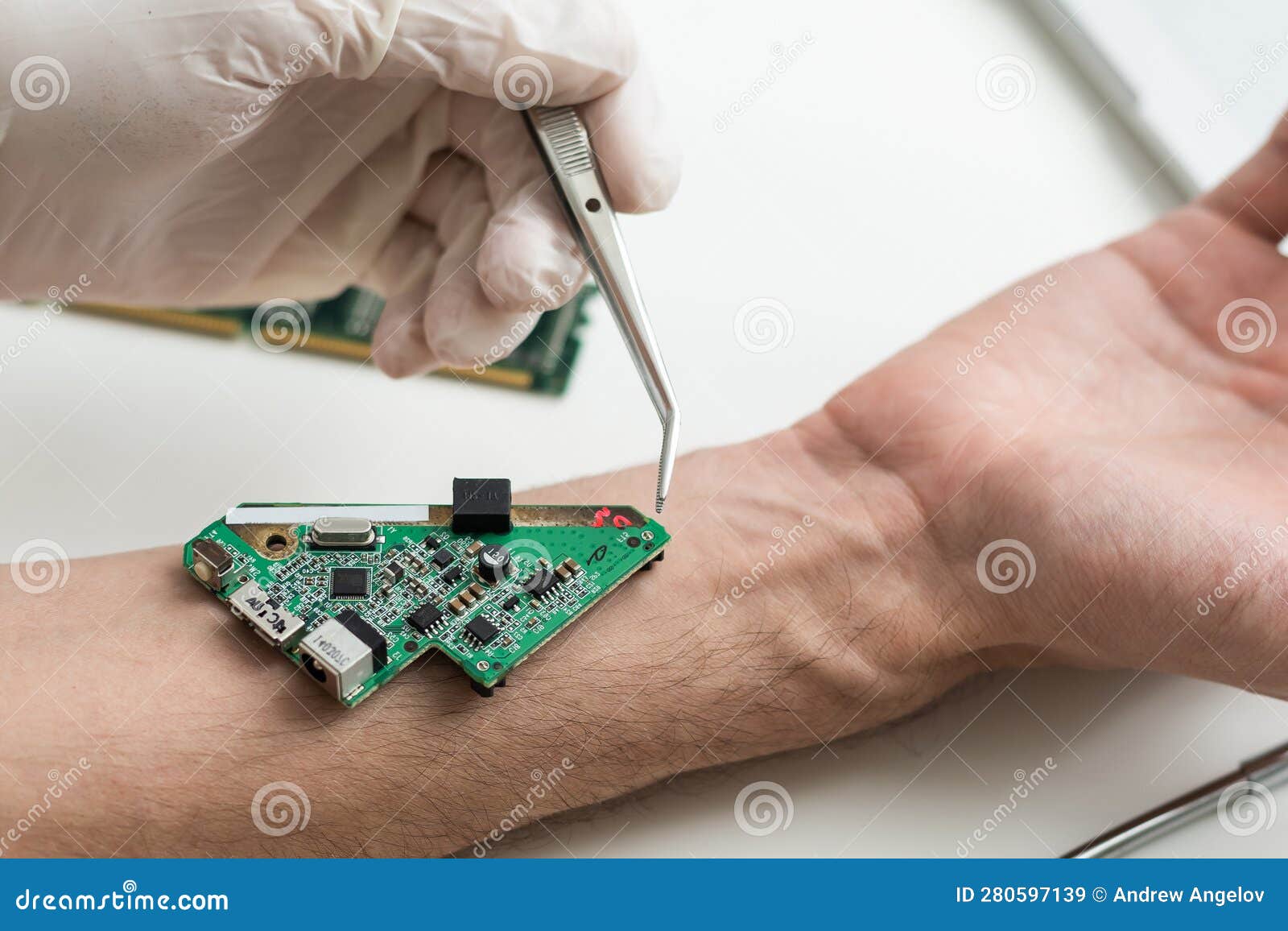 Hand with Implantation of Micro Chip. X-Ray View Close-up. Chipization ...