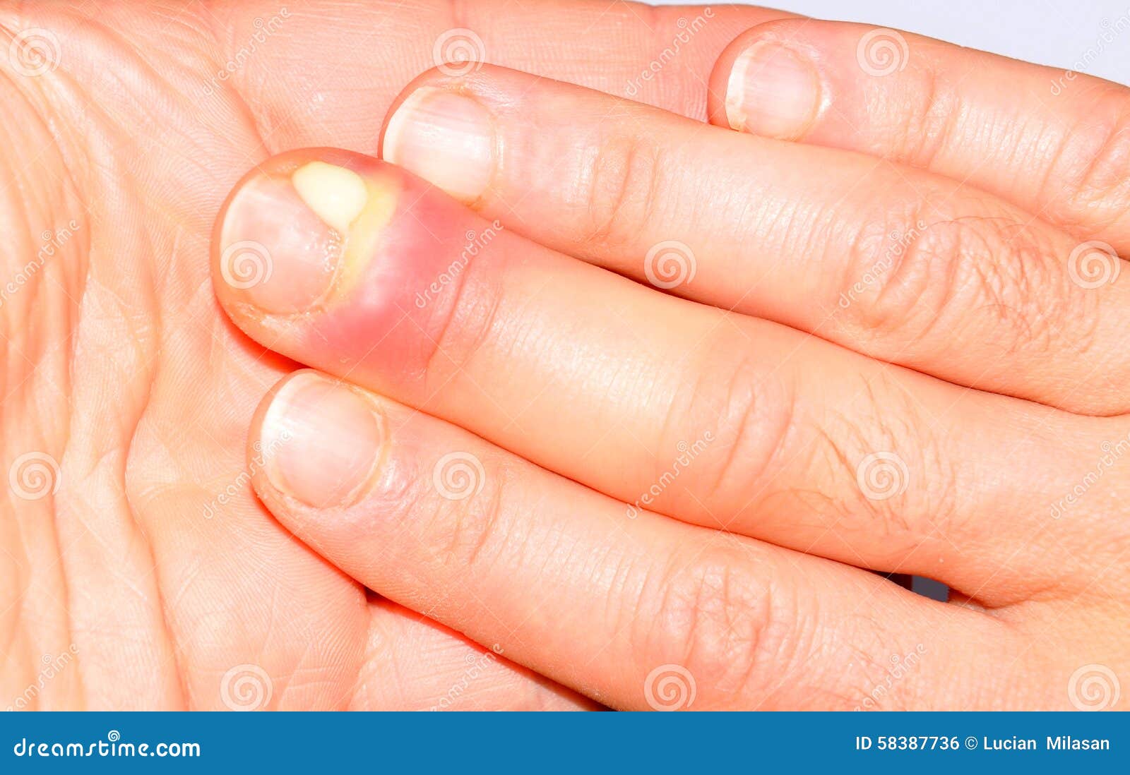 Finger Infection. Paronychia, Onychomycosis, Nail Psoriasis ...