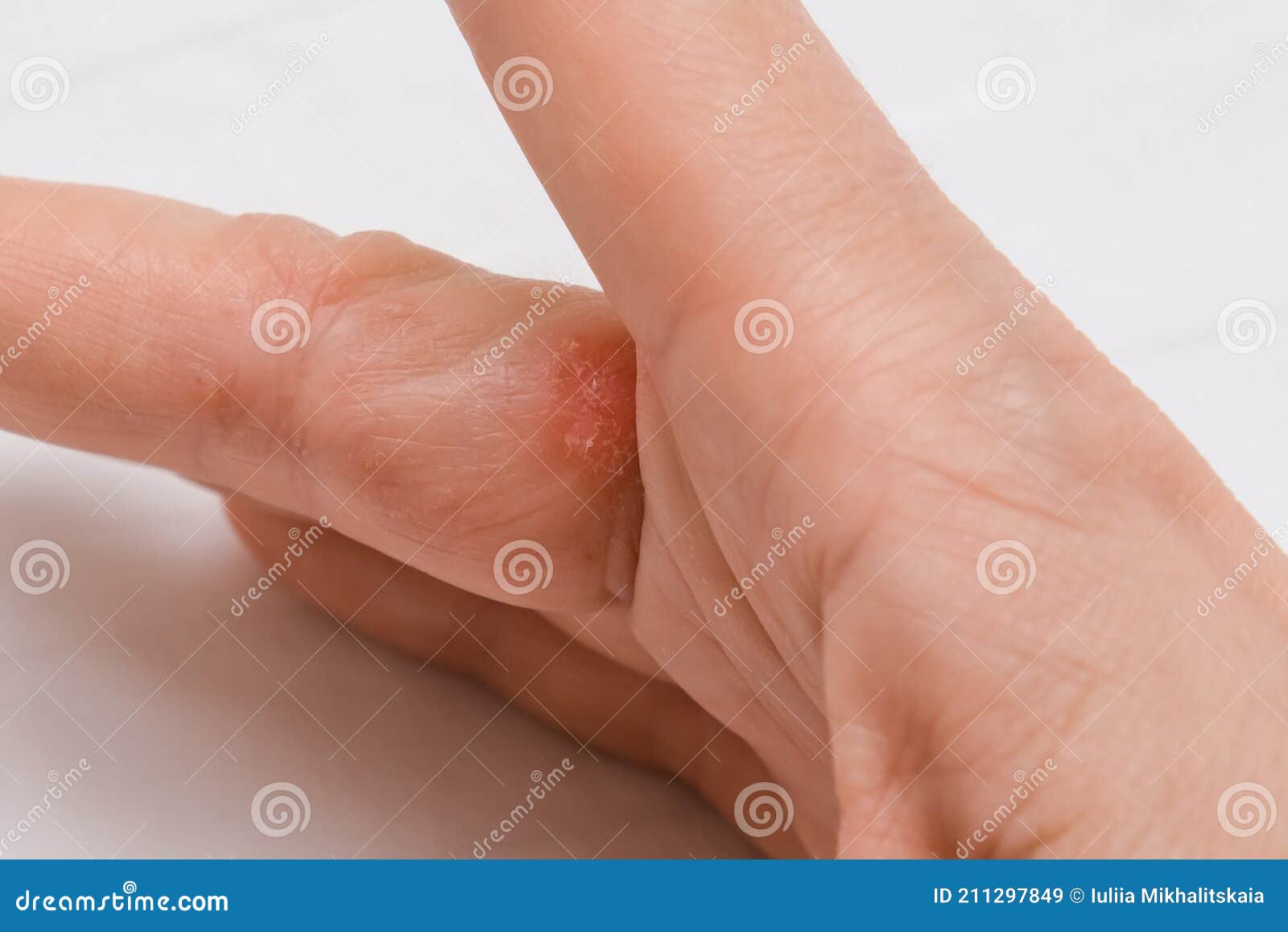 Hand with Interdigital Dermatitis, Dyshidrotic Eczema on Hand Close Up ...