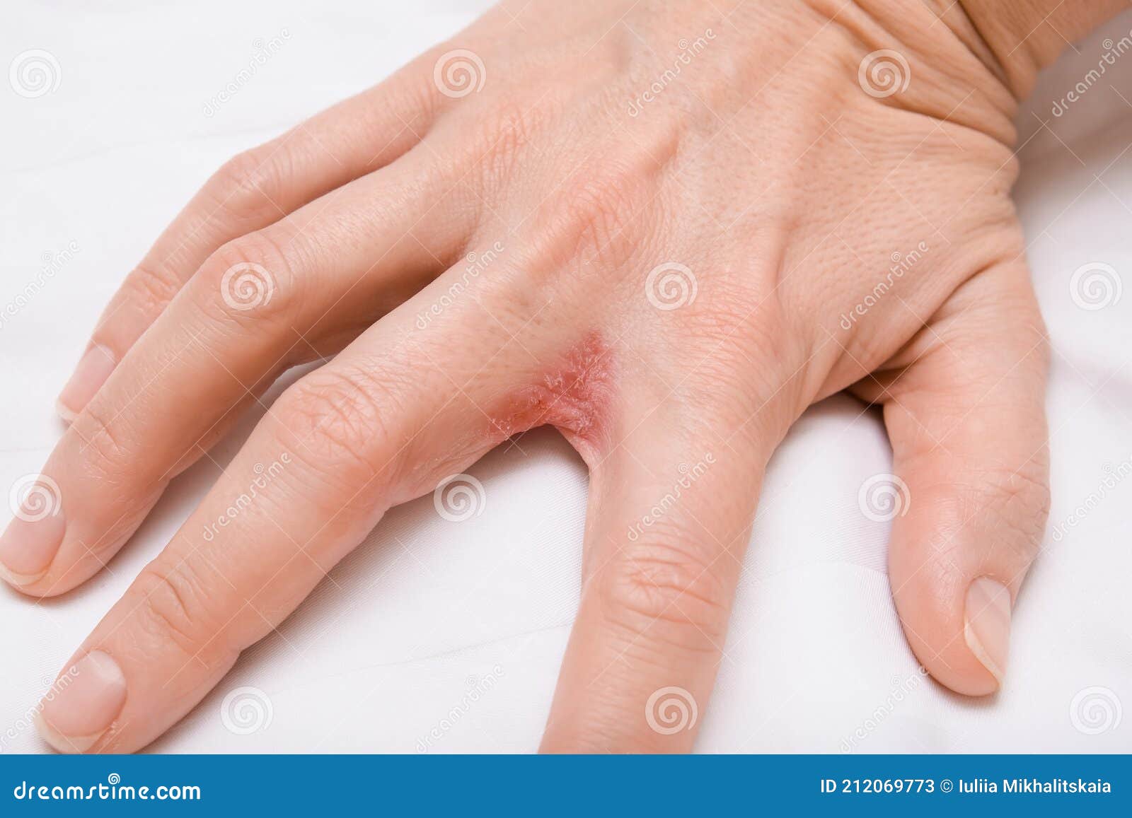 Interdigital Dermatitis Stock Photos - Free & Royalty-Free Stock Photos ...