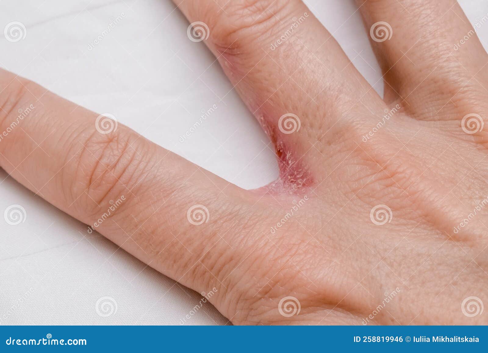 Dyshidrotic Eczema, Also Known As Pompholyx Or Cheiropompholyx, In The ...