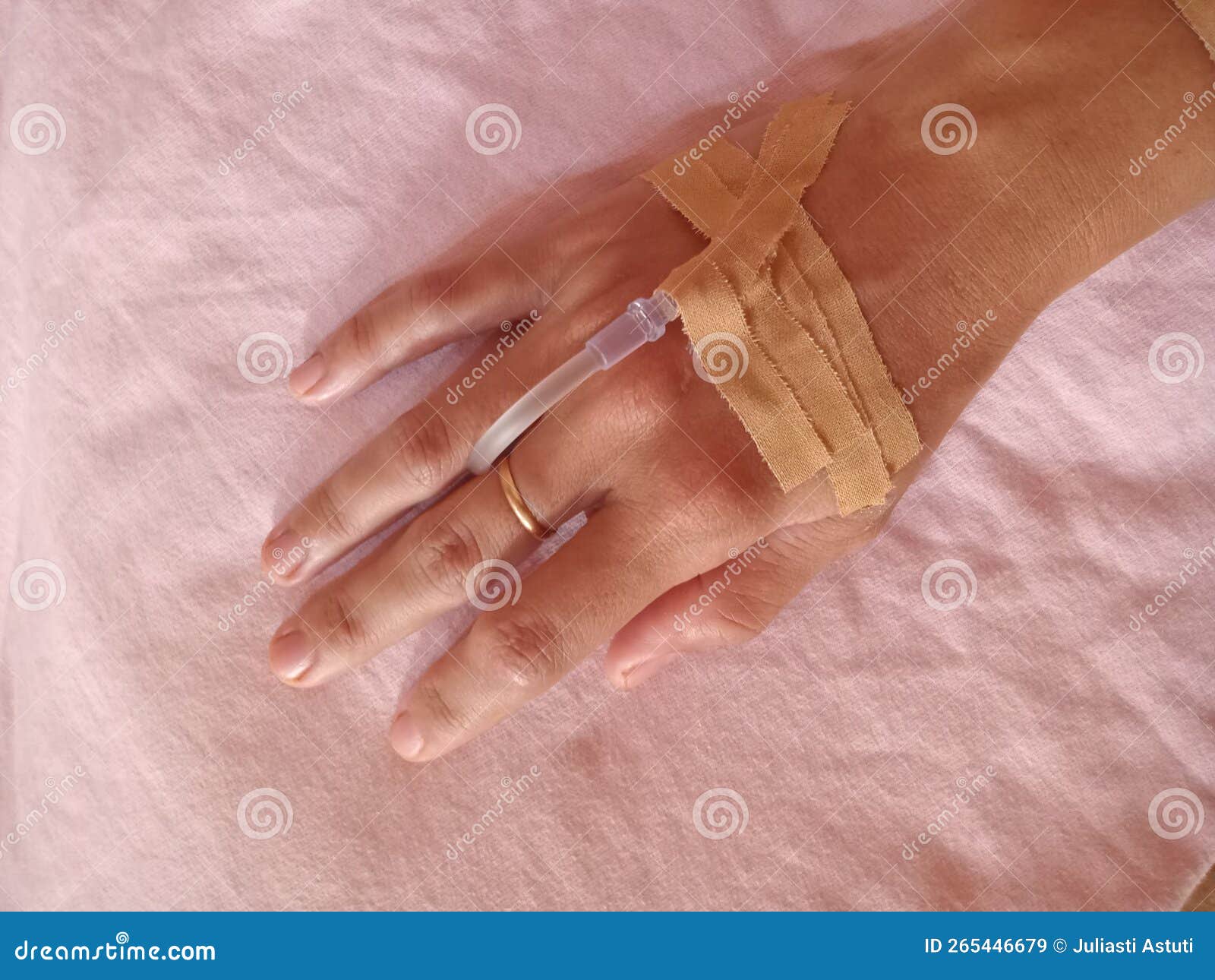 A hand with an IV attached stock image. Image of limb - 265446679