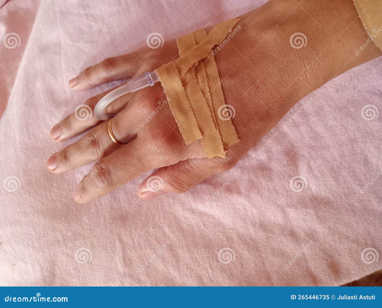 A hand with an IV attached stock image. Image of organ - 265446735