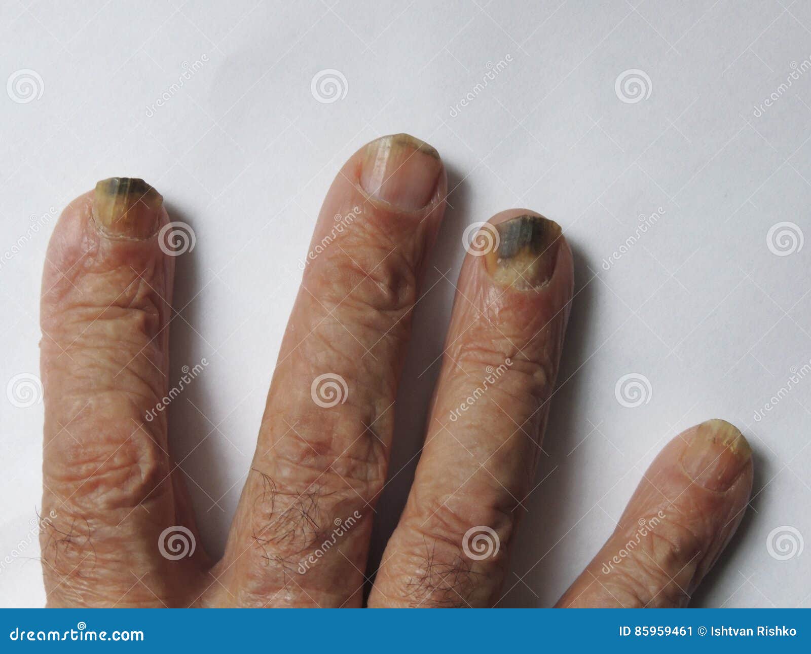 Hand of a Man with Nail Fungus Stock Image - Image of background, adult ...