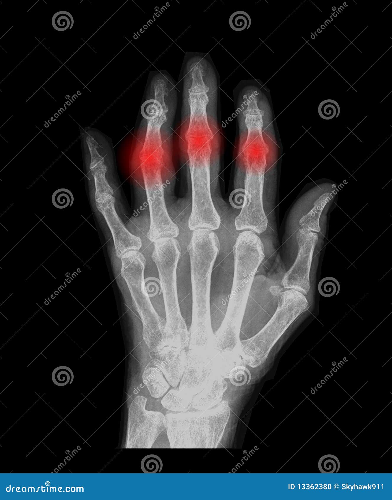 Hand met artrose stock illustratie. Illustration of negatief - 13362380