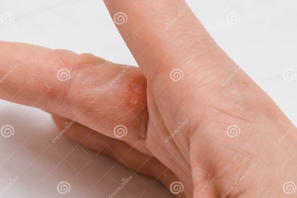 Hand Met Interdigital Dermatitis Dyshidrotic Eczeem, Hand in Hand Stock ...
