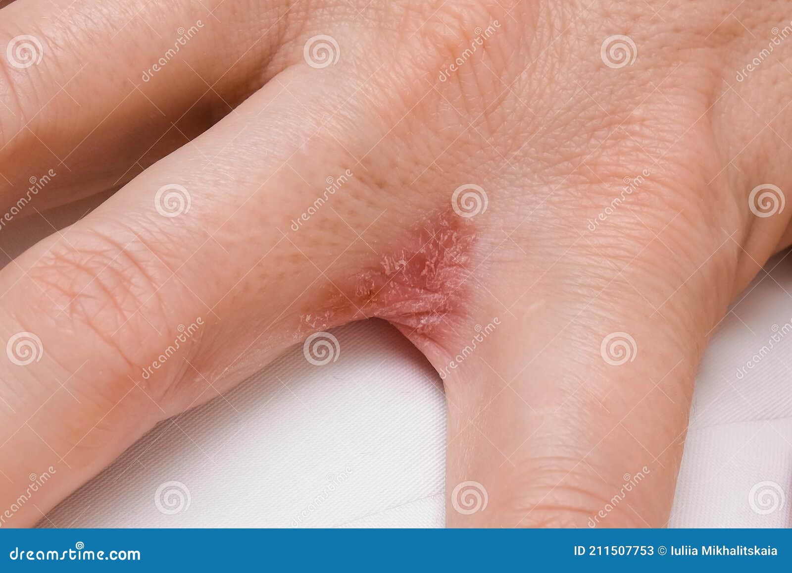 Hand Met Interdigital Dermatitis Dyshidrotic Eczeem, Hand in Hand Stock ...