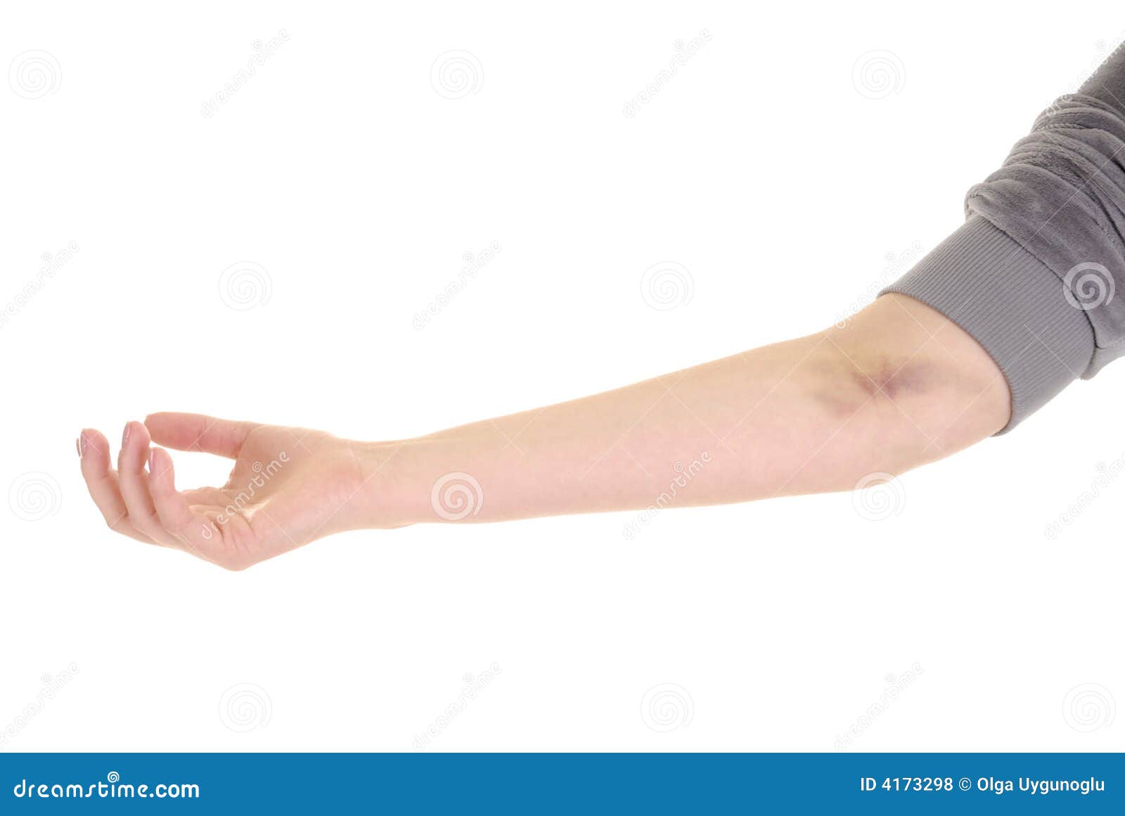 Hand mit Quetschung stockfoto. Bild von konflikt, leute - 4173298