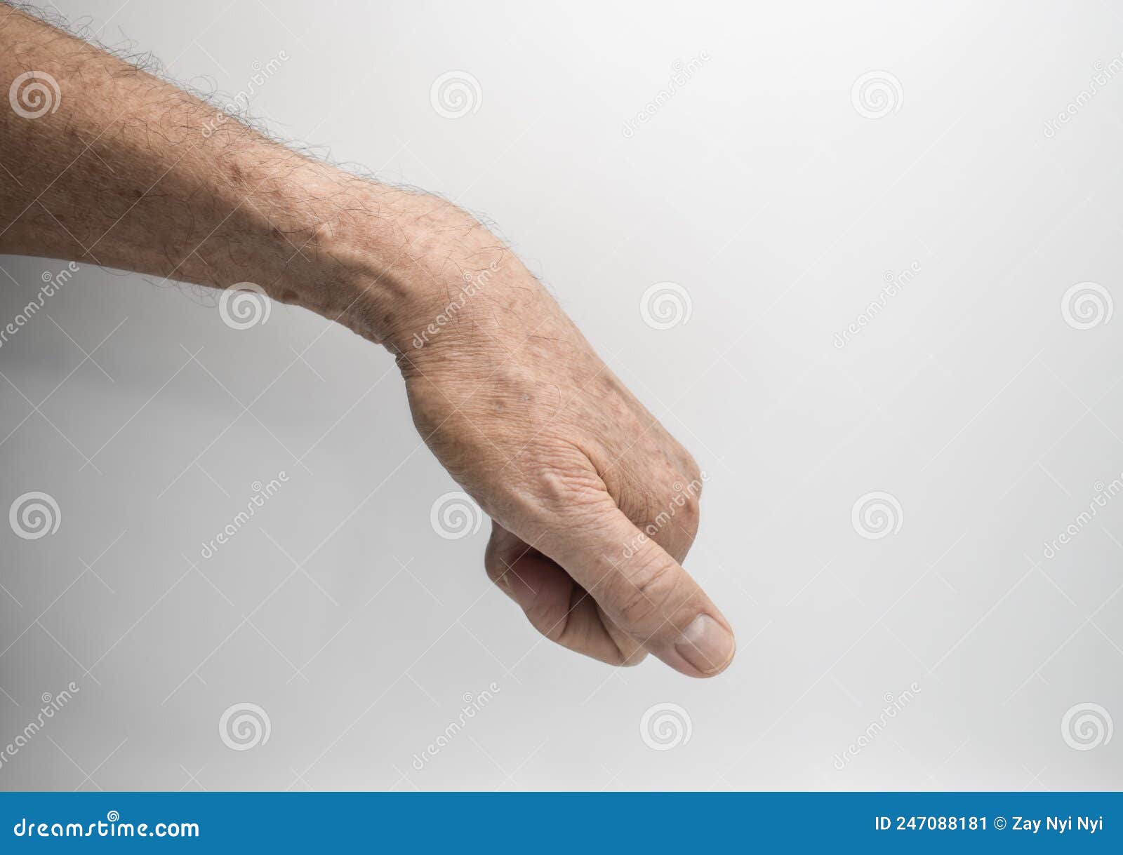 Rigid Finger Muscles In Asian Young Man. Unilateral Hand Muscle Spasm ...