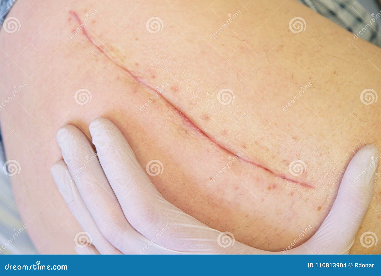 The Hand of the Nurse Performs the Hip Massage. Patient with a Long ...