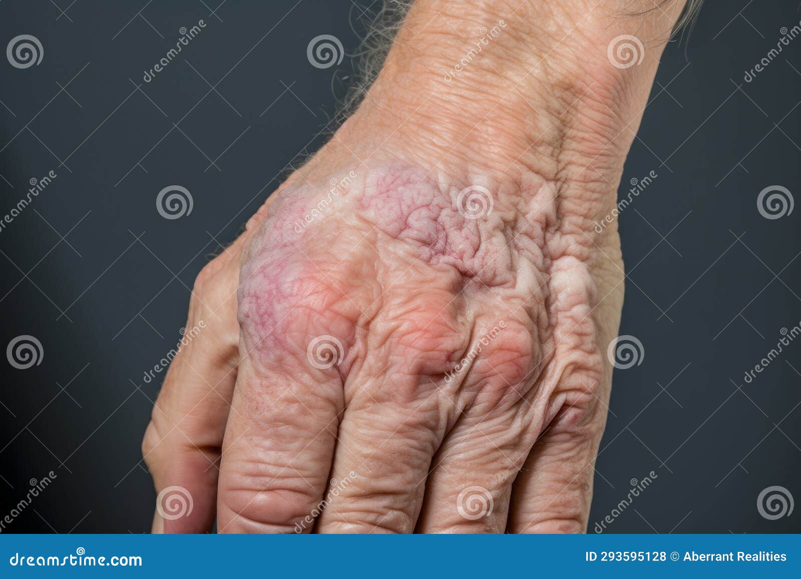 The Hand of an Older Man with a Rash on it Stock Illustration ...