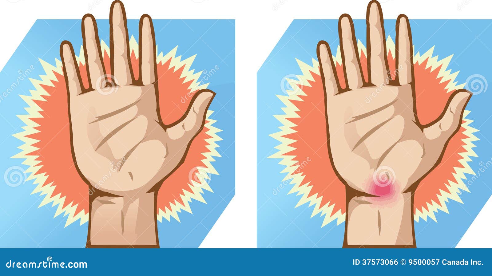 Hand pain stock vector. Illustration of syndrome, ergonomics - 37573066