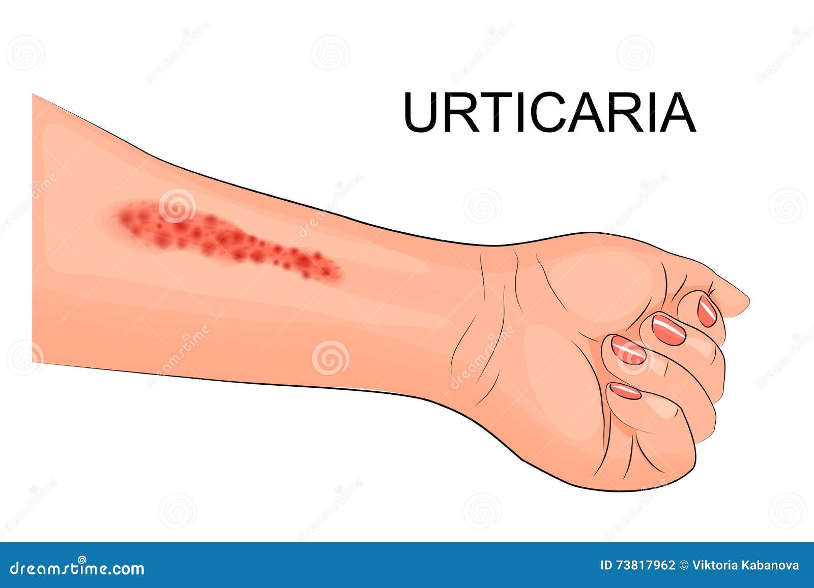 Hives Urticaria Vector Illustration. Labeled Skin Rash Explanation ...