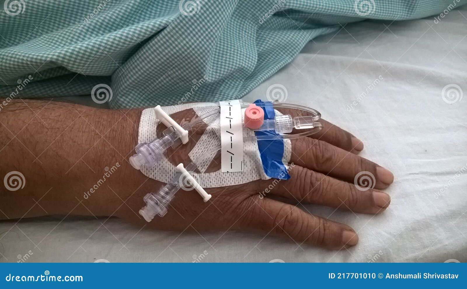 Hand with Peripheral Intravenous Cannulas or Catheters for Multipurpose ...