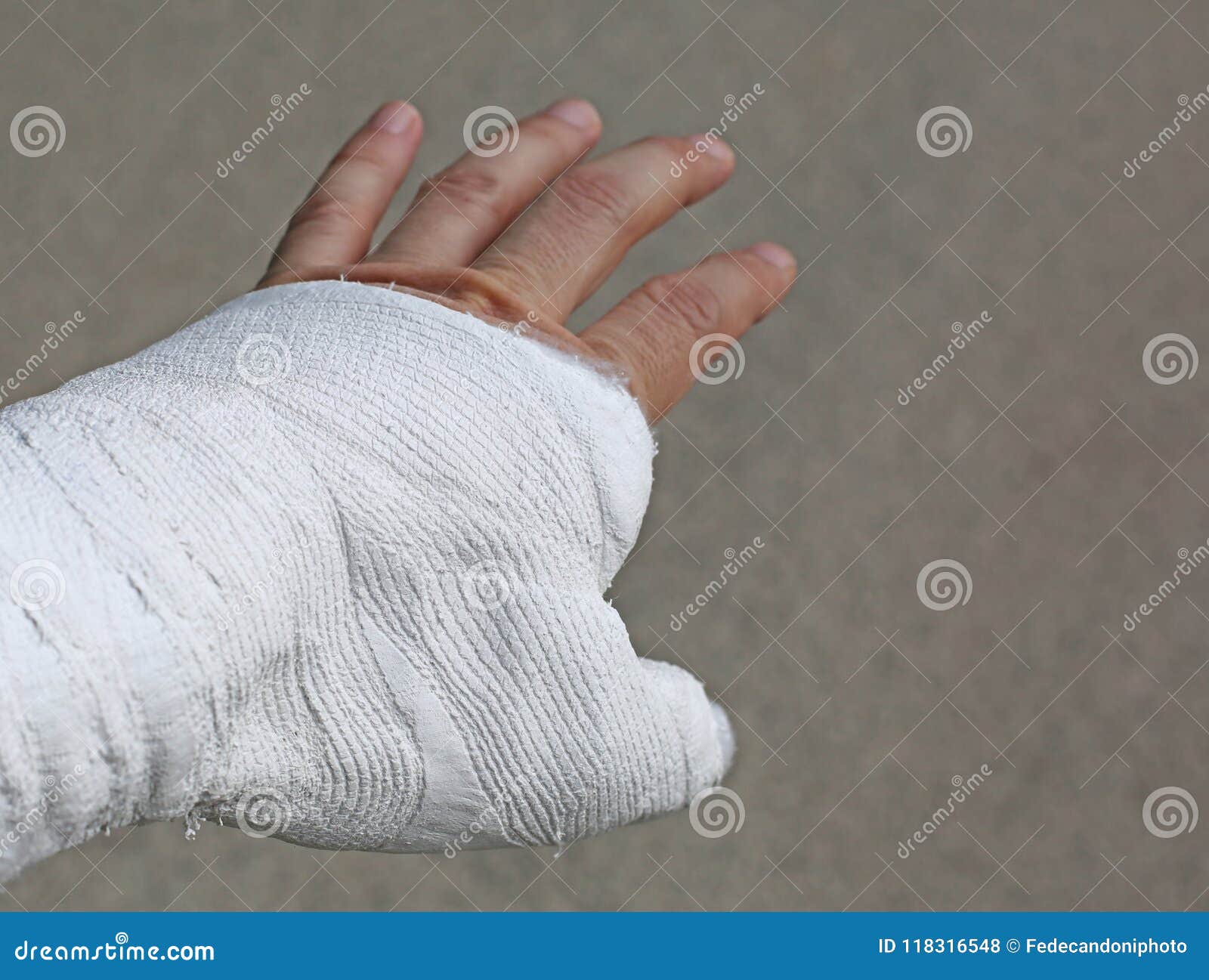 Hand Plastered Due To Fracture of the Bone Stock Photo - Image of ...